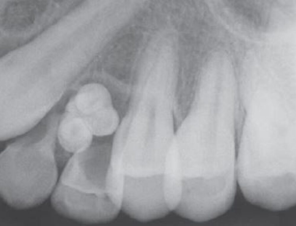 Idiopathic Osteosclerosis - Dr. Paul Mirdamadi DDS