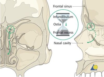 Frontal Sinus & Skull - Dr. Paul Mirdamadi DDS