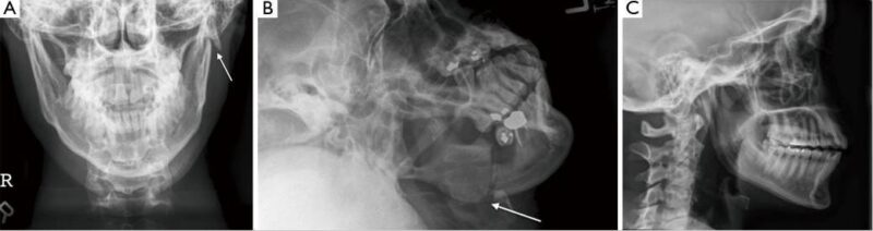 Mandible - Dr. Paul Mirdamadi DDS