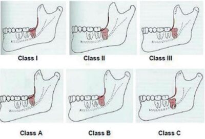 Wisdom Teeth - Dr. Paul Mirdamadi DDS