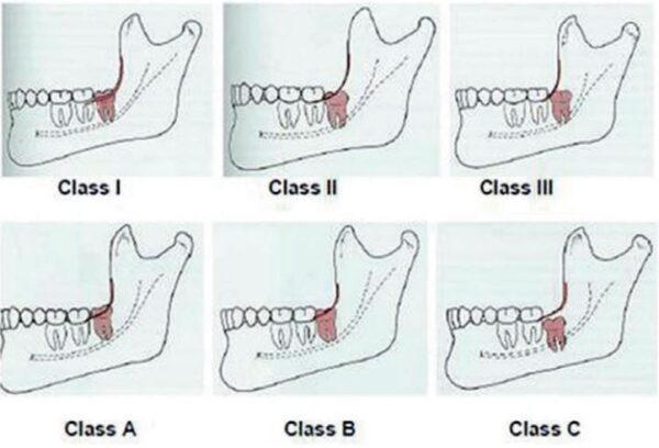 Wisdom Teeth - Dr. Paul Mirdamadi DDS