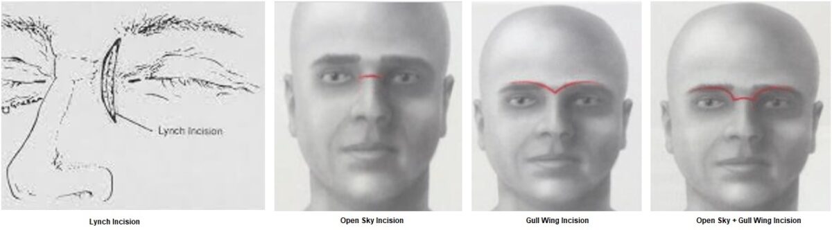 Naso-Orbital-Ethmoid Complex - Dr. Paul Mirdamadi DDS