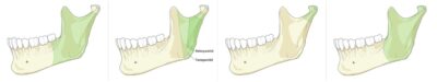 Mandible - Dr. Paul Mirdamadi DDS