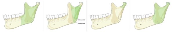Mandible - Dr. Paul Mirdamadi DDS