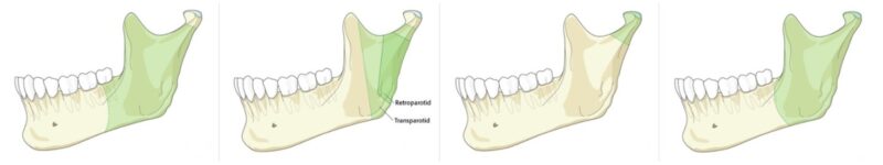 Mandible - Dr. Paul Mirdamadi DDS