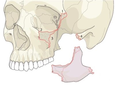 Midface - Dr. Paul Mirdamadi DDS