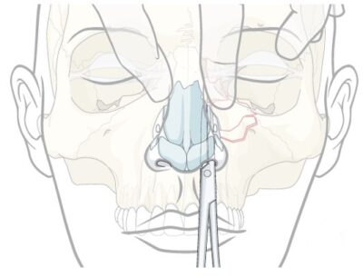 Naso-Orbital-Ethmoid Complex - Dr. Paul Mirdamadi DDS