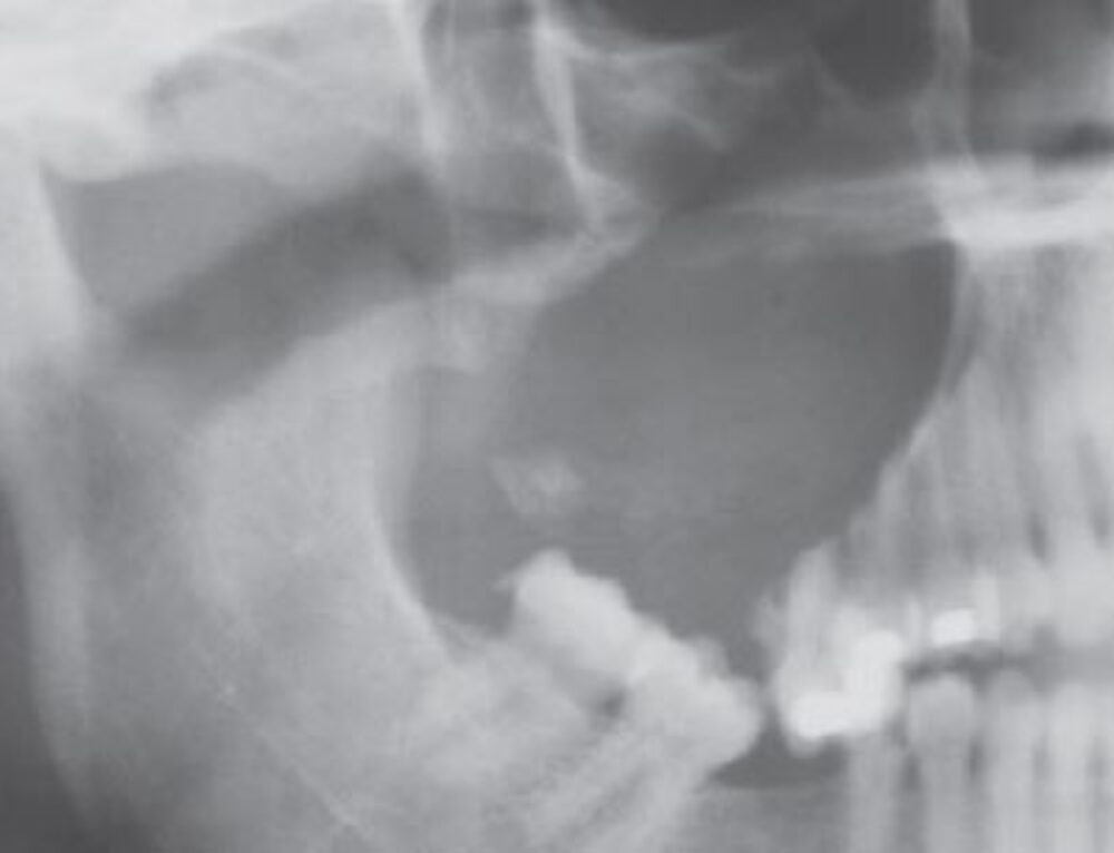 Ameloblastic Fibroma - Dr. Paul Mirdamadi DDS