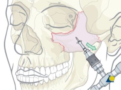 Midface - Dr. Paul Mirdamadi DDS