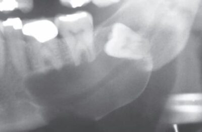 Dentigerous Cyst - Dr. Paul Mirdamadi DDS