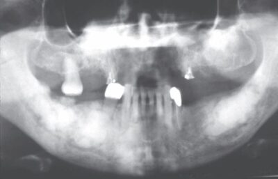 Cemento-Osseous Dysplasia - Dr. Paul Mirdamadi DDS