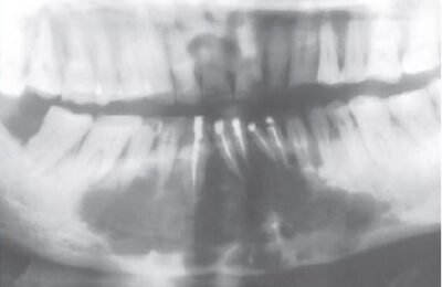 Odontogenic Cysts - Dr. Paul Mirdamadi DDS