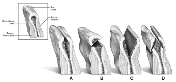 Iliac Crest Bone Harvest - Dr. Paul Mirdamadi DDS