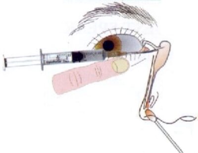 Naso-Orbital-Ethmoid Complex - Dr. Paul Mirdamadi DDS