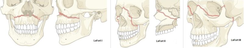 Midface - Dr. Paul Mirdamadi DDS