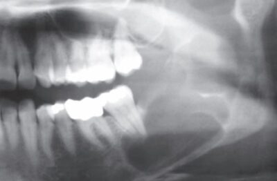Odontogenic Cysts - Dr. Paul Mirdamadi DDS