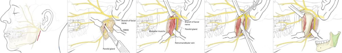 Mandible - Dr. Paul Mirdamadi DDS