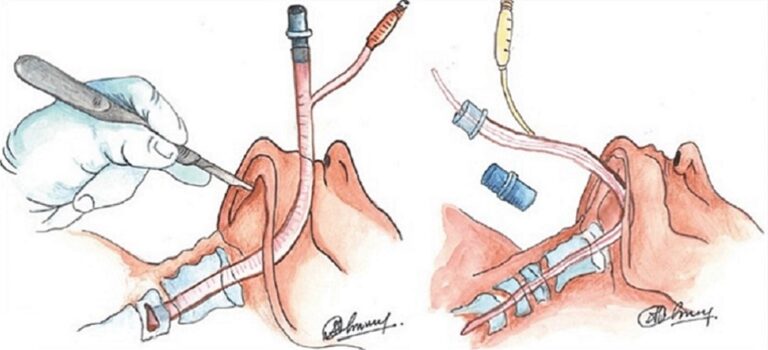 Submental Intubation - Dr. Paul Mirdamadi