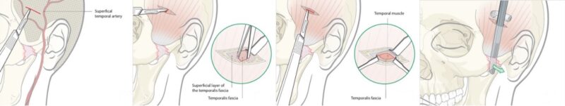 Midface - Dr. Paul Mirdamadi DDS