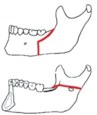 Bilateral Sagittal Split Osteotomy (BSSO) - Dr. Paul Mirdamadi DDS