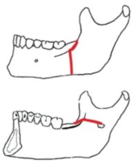 Bilateral Sagittal Split Osteotomy (BSSO) - Dr. Paul Mirdamadi DDS