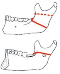 Bilateral Sagittal Split Osteotomy (BSSO) - Dr. Paul Mirdamadi DDS