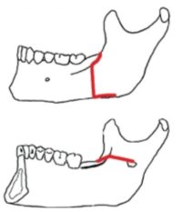 Bilateral Sagittal Split Osteotomy (BSSO) - Dr. Paul Mirdamadi DDS
